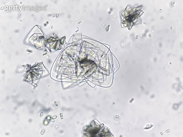 Uric acid crystals and calcium oxalate monohydrate under microscope 이미지 ...