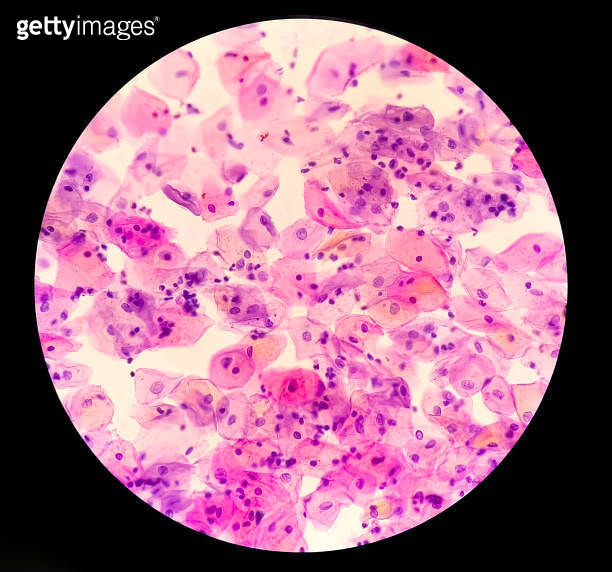 Atypical squamous cells of undetermined significance, it may be a sign ...
