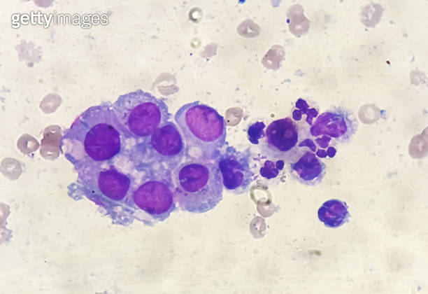 Malignant fluid cytology; Cells of adenocarcinoma may spread to fluid ...