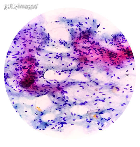 Microscopic examination of Breast lump FNAC showing Galactocele, it is ...