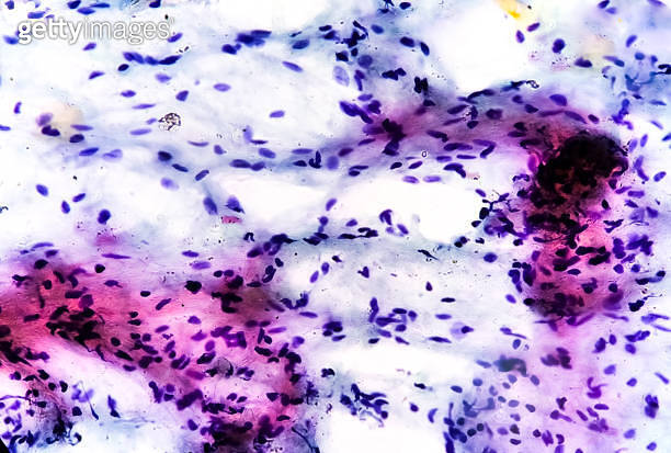 Microscopic examination of Breast lump FNAC showing Galactocele, it is ...