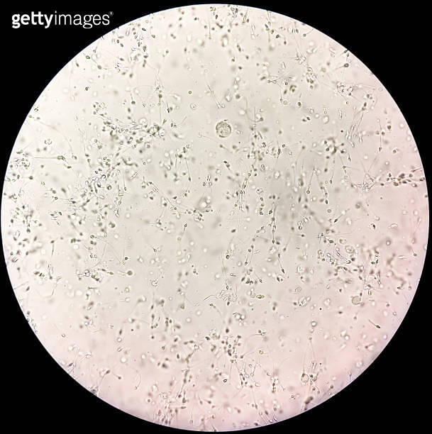 Sperm morphology. Semen photo under microscope. Micrograph showing ...