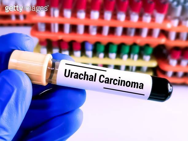 Urachal cancer or Urachal carcinoma, a rare type of non urothelial ...