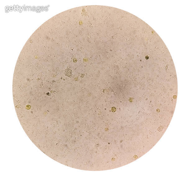 Microscopic view of stool sample showing Cyst of Entamoeba histolytica ...