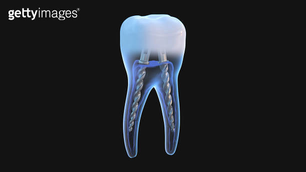 Dental steel post inside molar teeth, Xray view. Dental endodontic ...