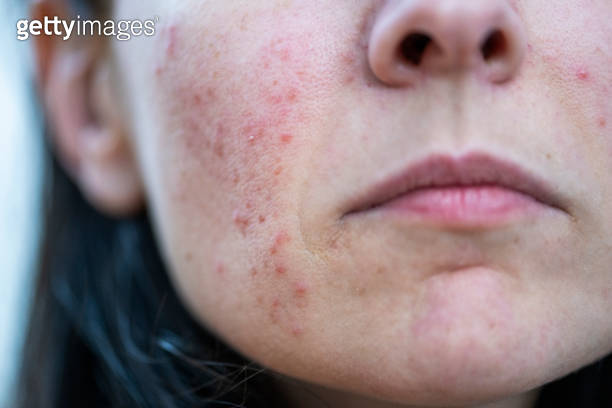 Psoriasis rosacea - skin inflammation on a face of a young woman 이미지 ...