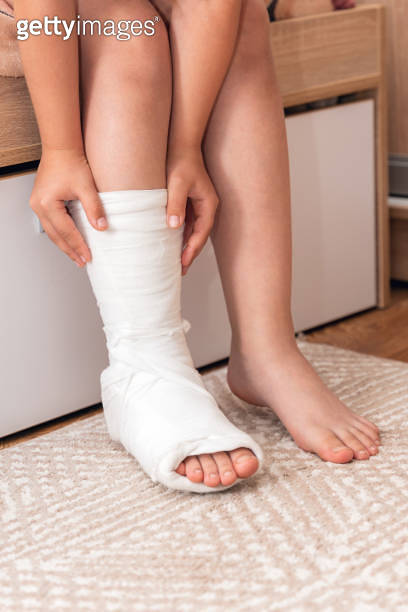 Children's legs, one leg is broken and in a cast 이미지 (2160719621) - 게티이미지뱅크