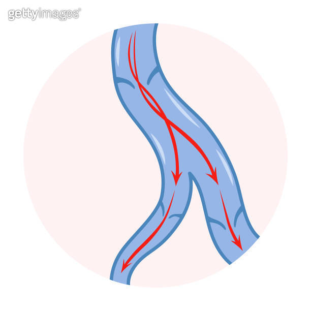 Varicose veins. Blue blood vessel visible through the skin. Vascular ...