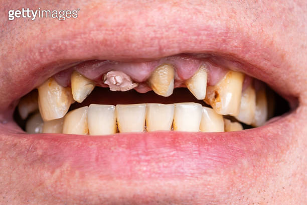 Periodontal disease, loose teeth in toothless man mouth, close up ...