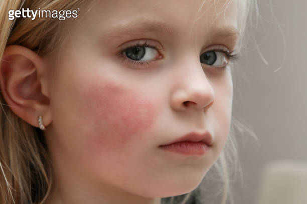 Redness on child's cheeks caused by eczema, dry skin or allergy ...