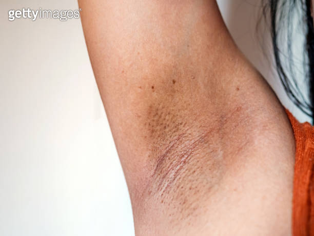 Close-up of Women armpit with problem black armpit. Dark and wrinkle ...