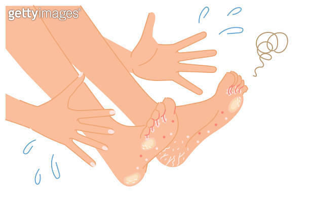 Illustration of a woman surprised by athlete's foot, corns, and ...
