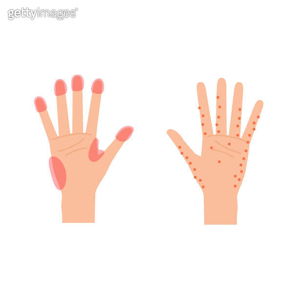 Illustration of common areas for hand eczema and sweat rash (female ...