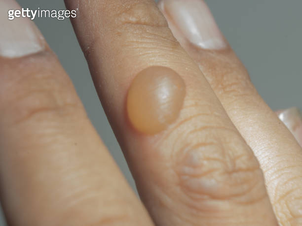 Male hand with blister finger heat hot fire skin injury closeup with ...