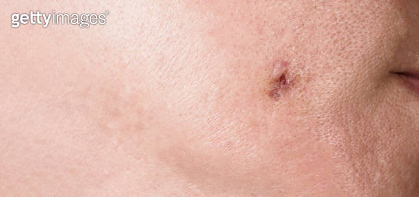 Scars from facial abscess or big acne surgery. Scars from inflammation ...