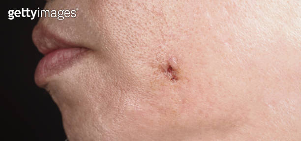 Scars from facial abscess or big acne surgery. Scars from inflammation ...