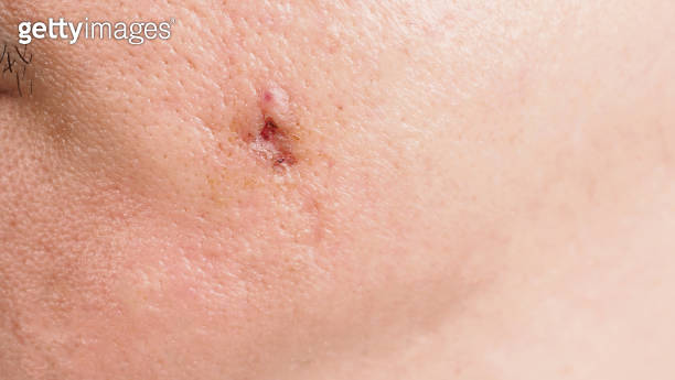 Scars from facial abscess or big acne surgery. Scars from inflammation ...