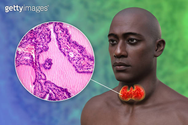 A man with enlarged thyroid gland, 3D illustration, and micrograph ...