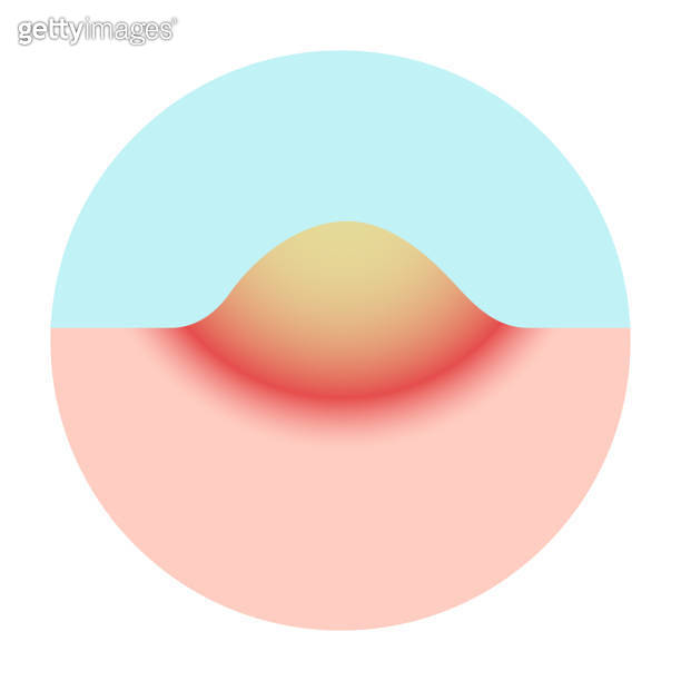 mpox, monkey pox disease. stage 4 pustule macule of Mpox skin symptom ...