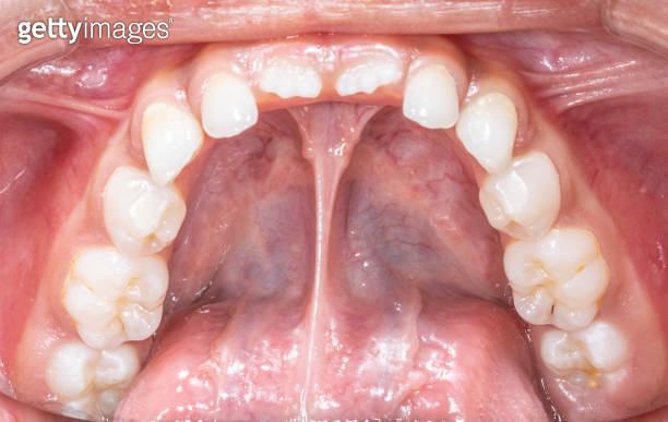 Lower mandibular arch of a child milky dentition and permanent incisors ...