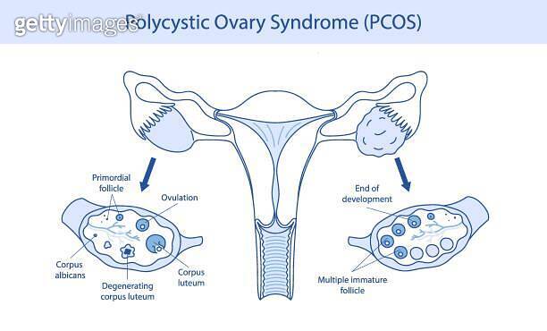 Polycystic ovary syndrome PCOS. Ovarian cysts of the female ...