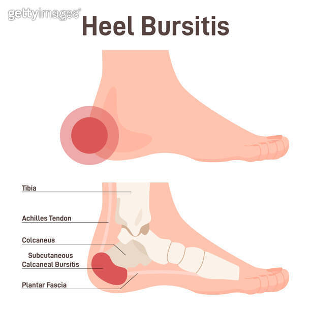 Types of bursitis. Shoulder, hip, heel, knee and elbow joints ...