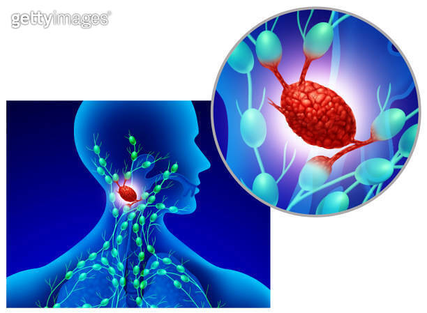 Swollen Lymph Node 이미지 (2151917078) - 게티이미지뱅크