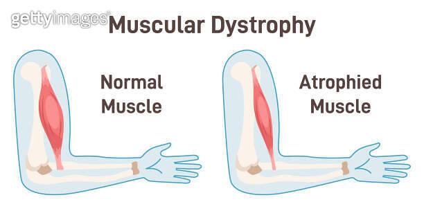 Muscular dystrophy. Healthy muscle versus atrophied one. Anatomical ...