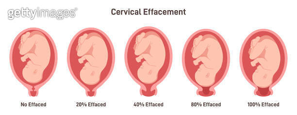 Cervical effacement set. Cervix dilation during delivery from not ...