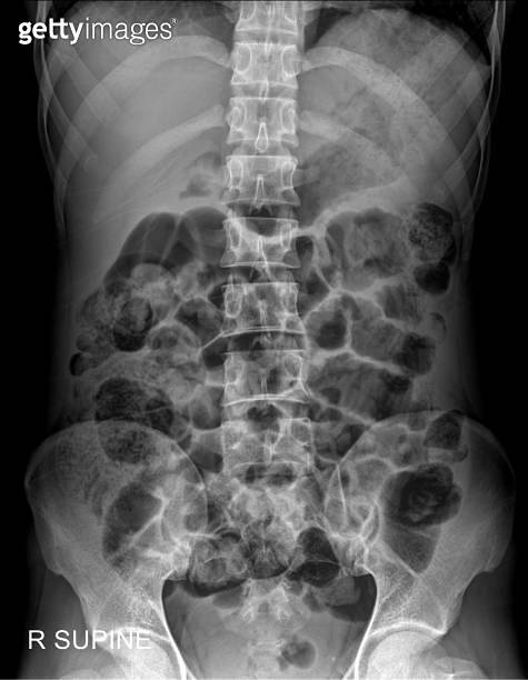 Inside Out: Abdominal X-Ray Images Shedding Light on Digestive Health ...