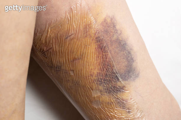 Woman legs after varicose vein surgery, with visible surgical sutures ...