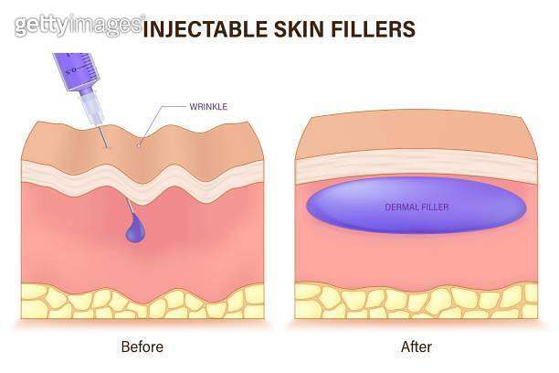 Injectable skin fillers. Dermal fillers. Skin before and after ...