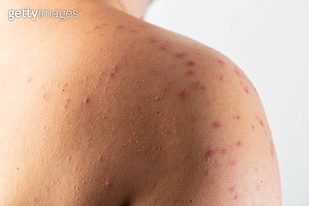 Red spots and rashes on the skin of the back and shoulders after ...