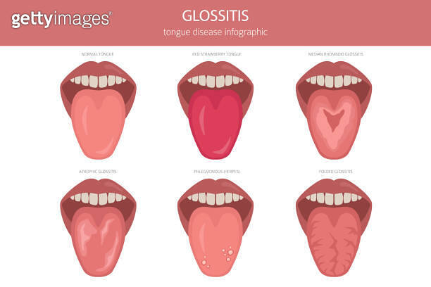 Glossitis tongue disease. Oral medicine. Medical infographic design ...