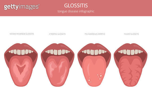 Glossitis tongue disease. Oral medicine. Medical infographic design ...