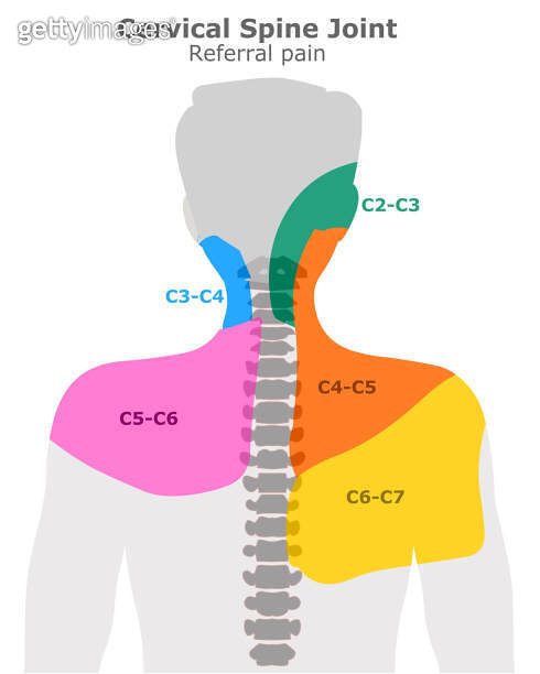 Cervical spine joint referral pain areas, Head, neck shoulder vertebral ...