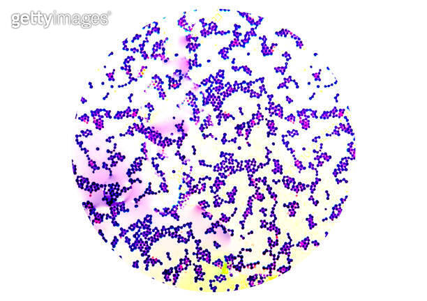Gram positive Staphylococcus appears in cluster form under the ...