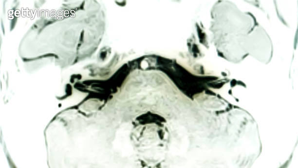 MRI Scan for Cochlea of the internal auditory canal (IAC). (2185943141 ...