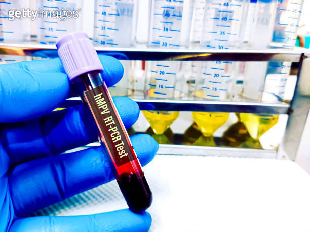 Blood sample for Human Metapneumovirus (hMPV) RT PCR test. (2192390620 ...