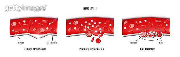 Hemostasis medical 3D infographic vector design, damage blood vessel ...