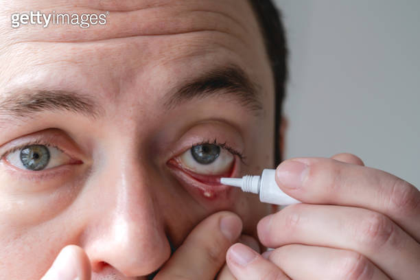 Close up of man's infected chalazion (stye, barley) or hordeolum eye ...