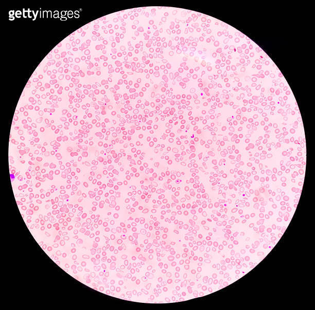 Hematological slide of Microscopic image showing severe microcytic ...