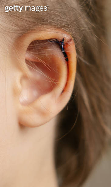 Stitches on the kid torn ear, dissection, suturing, bruise on the ear ...