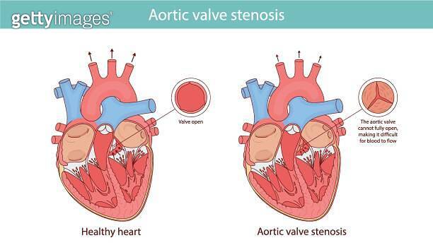 A medical illustration shows the difference between a normal artis ...